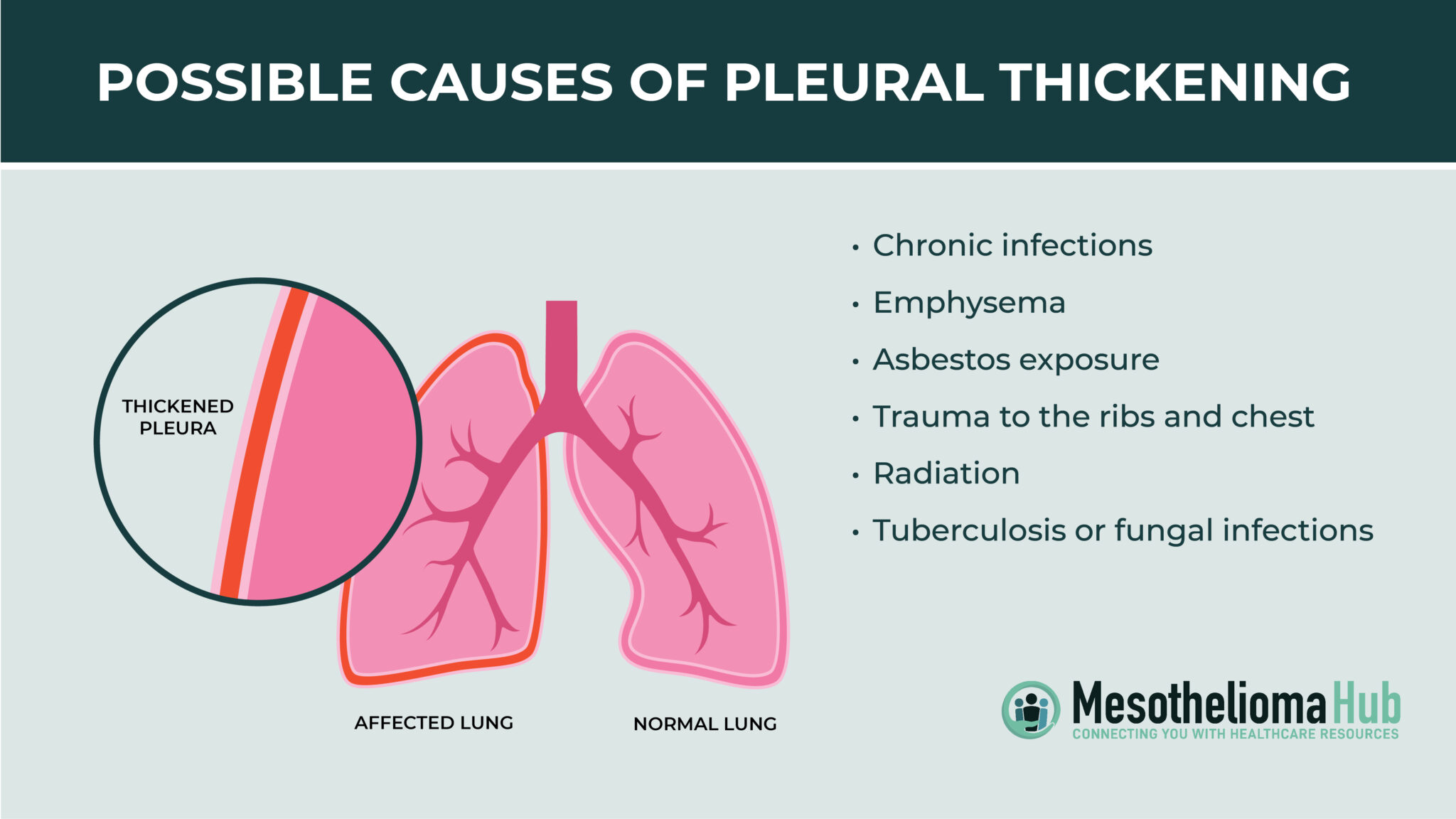 Pleural Thickening - Symptoms, Diagnosis, and Treatments Pleural Thickening - Symptoms, Diagnosis, and Treatments